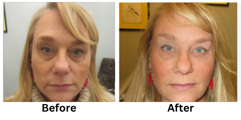 Revanesse Versa Filler Before After Photos